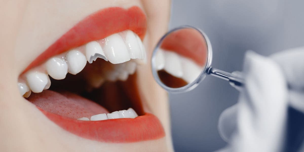 Broken Tooth Management – Microsmiles Dental Care